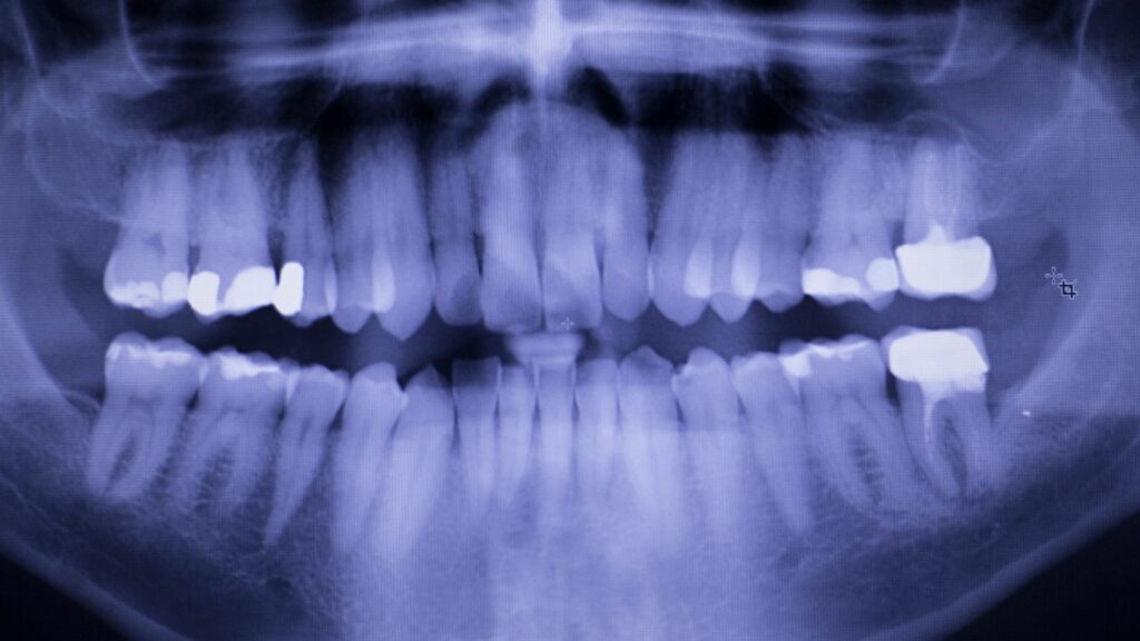 5 Types of Teeth Fillings & Which is the Best? - KB Village Dental